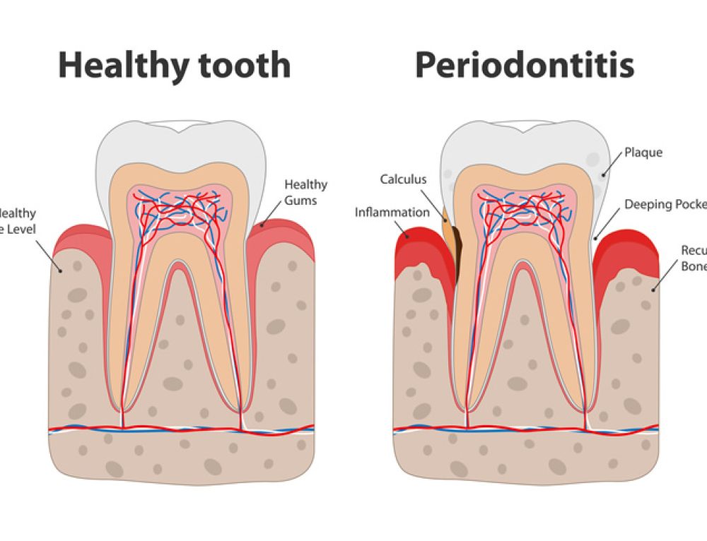 What Is Periodontitis?